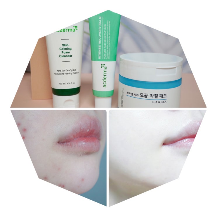 화농성여드름 원인 그리고 해결법 네이버 블로그