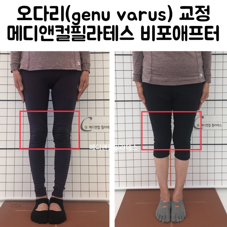 내외동 필라테스 60대 후반 회원님 O다리(genu varus) 교정 사례 : 네이버 블로그