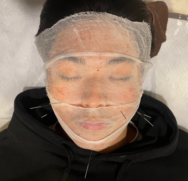 중학생 여드름 한의원 치료 화농성 속 여드름 결절성 압출 여드름 팩 착색 관리 후기 네이버 블로그
