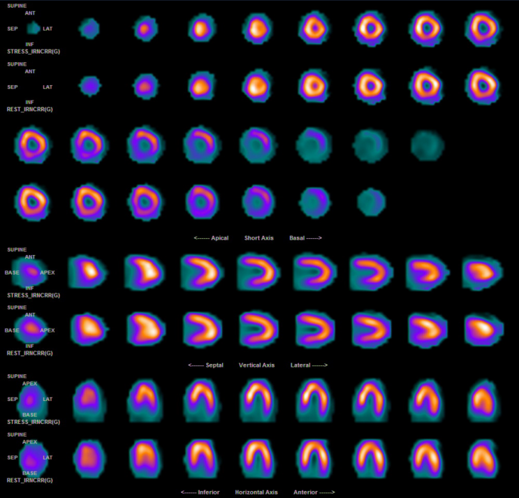 심근관류 SPECT 검사 결과 나옴 : 네이버 블로그