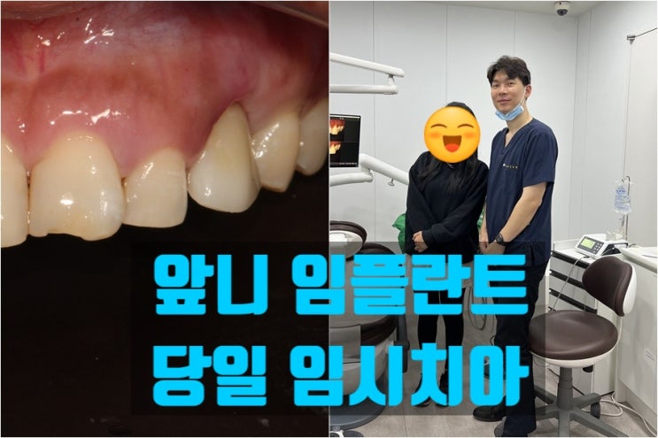 앞니 임플란트 수술 임시치아까지 당일에 한 경우 Feat 치주염 엑스레이 보는 방법 네이버 블로그