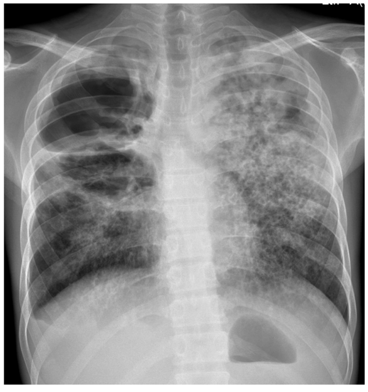 활동성 폐결핵 증례, 폐렴, 공동 : 네이버 블로그