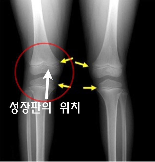 빛고을생생병원 강좌 소아 정형외과 전문의가 알려주는 성장판 골절 네이버 블로그