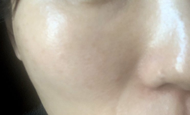 피코슈어 토닝 후기 2차 내돈내산 솔직 후기 흑자 기미 잡티 제거 맞춤 집중 치료 피부과 레이저 시술 전후