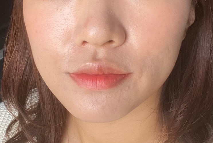 알라딘필해초필 2회차 좁쌀여드름 화농성 치료 후기 네이버 블로그