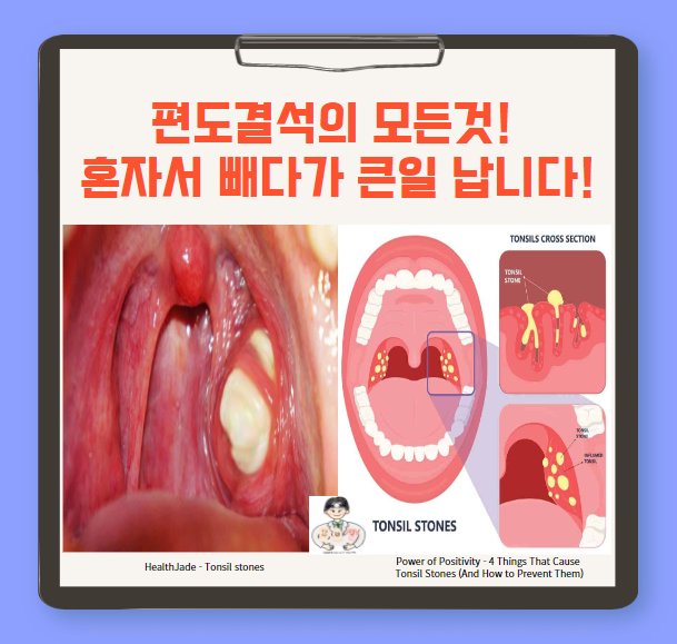 편도결석(Tonsillolith)의 모든것! 혼자서 빼다가 큰일 납니다! : 네이버 블로그
