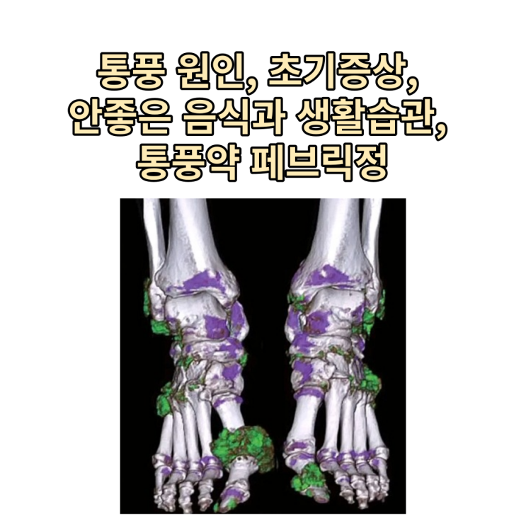 통풍 원인 초기증상 안좋은 음식과 생활습관 통풍약 페브릭정 네이버 블로그