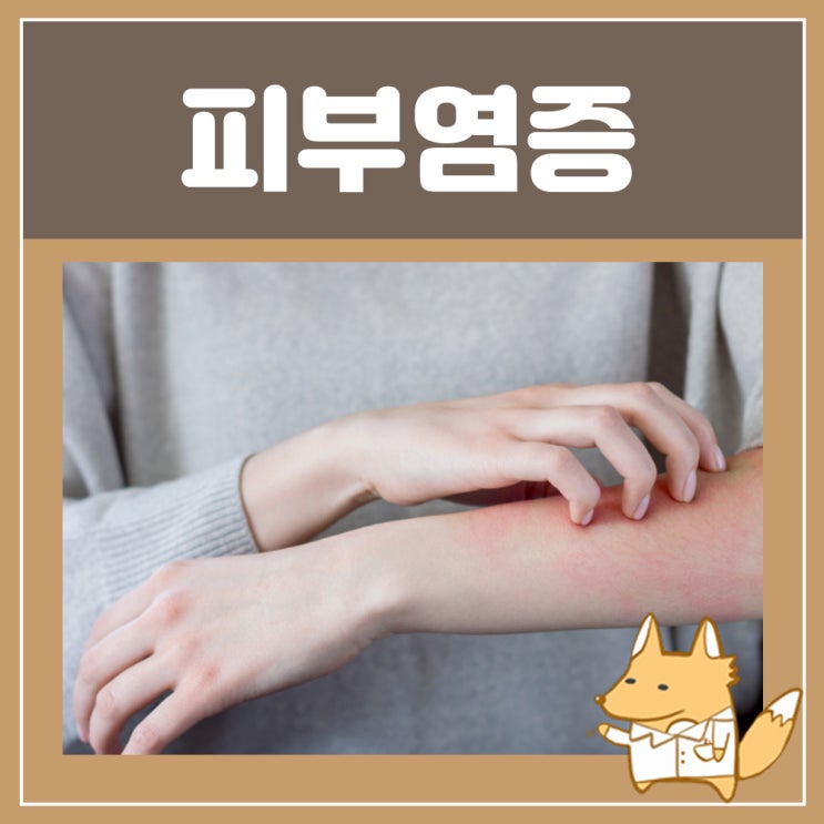 피부염증 치료 리도맥스 에스로반 박테로신 땀띠 주부 습진 연고 항생제 연고 스테로이드 연고 네이버 블로그
