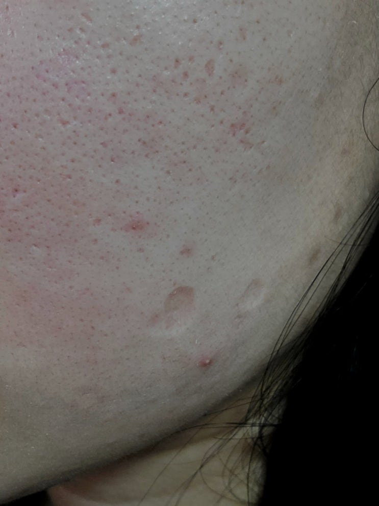 홍대 흉터치료 찐후기 내돈내산 새살침 코라테라피 1회차 네이버 블로그