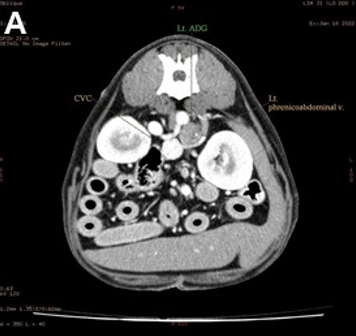 갈색세포종 (Pheochromocytoma) 으로 진단된 MMVD 환자에서 부신 절제술을 통한 임상증상 및 심장병 개선 증례 ...