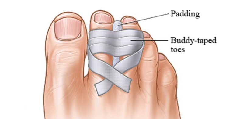 손가락 발가락 골절 처치, 버디테이핑 buddy taping : 네이버 블로그
