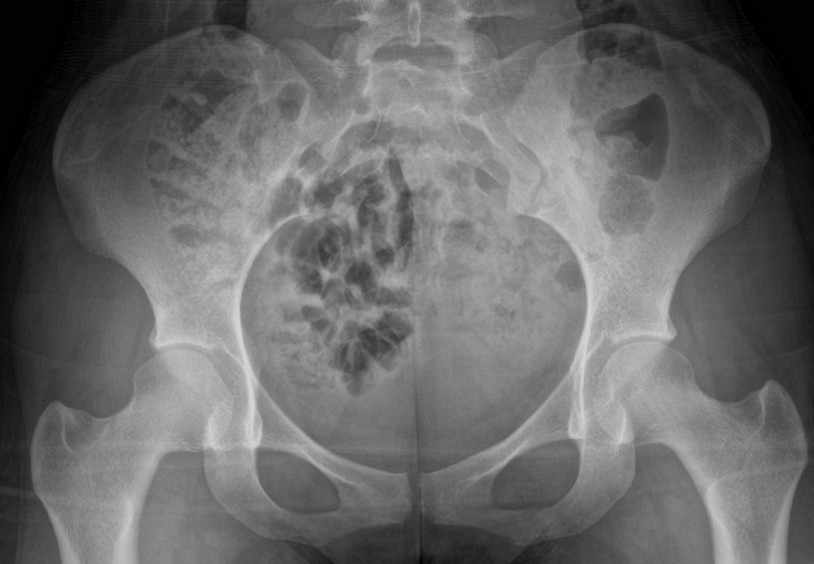 Risser stage & 척추측만증 : 네이버 블로그