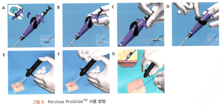혈관폐쇄기구의 사용방법 3th- Perclose ProGlide : 네이버 블로그