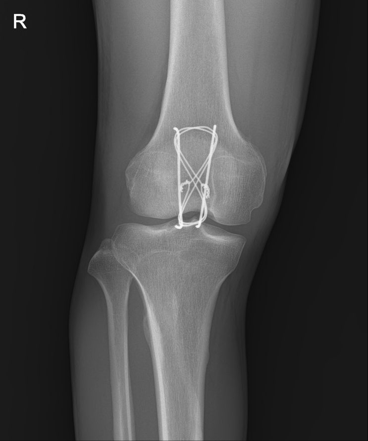 심한 슬개골 골절patella Fracture에서 시행한 봉합 나사못과 긴장강선 고정을 이용한 고정술 올바른서울병원
