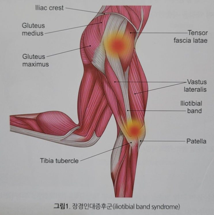 장경인대 증후군 걸을때마다 무릎부위 외측이 아파요 네이버 블로그