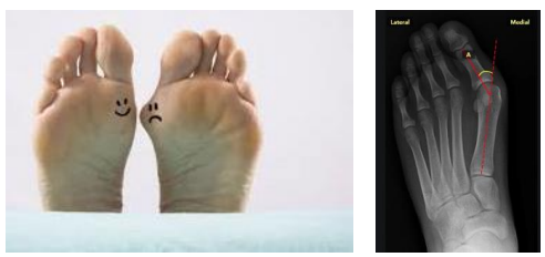 무지외반증(Hallux valgus)의 원인과 개선 전략 : 네이버 블로그