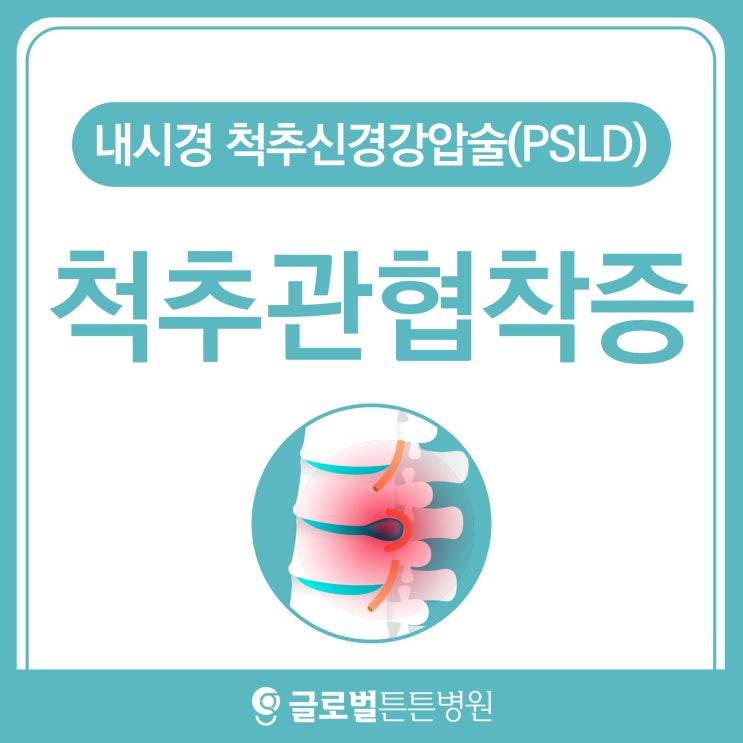[대전 척추병원] 척추관협착증! 부담 줄인 PSLD 척추내시경 치료 : 네이버 블로그