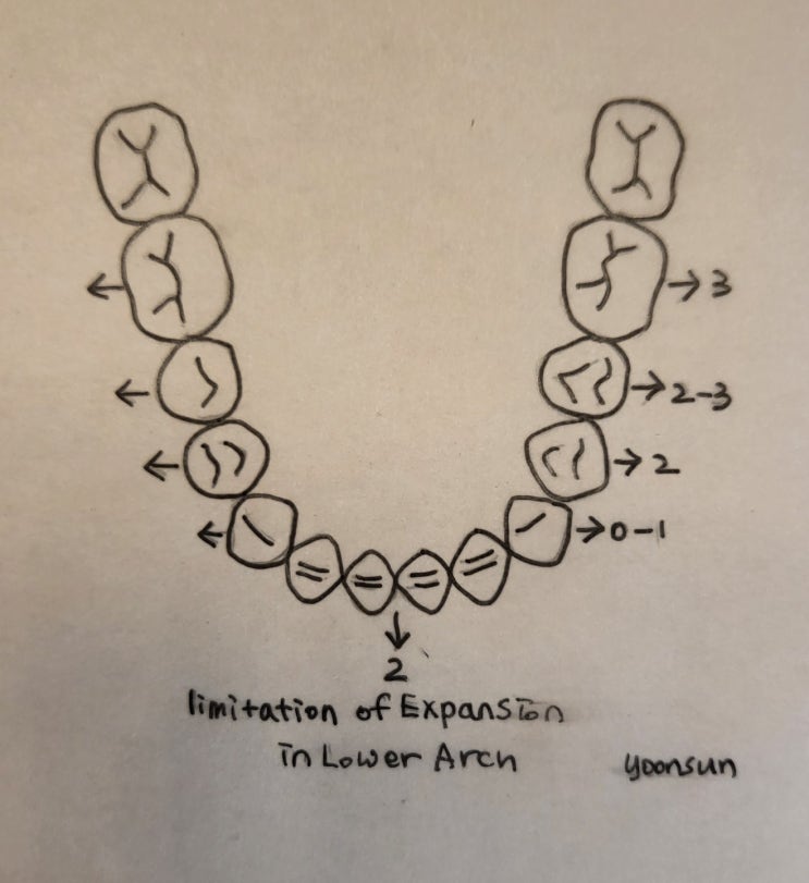 Extraction versus Expansion (발치 vs 확장) : 네이버 블로그