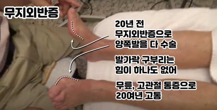 44. 무지외반증 수술 후 통증과 만성 피로 KSNS 스본 스도 4회로 해결 : 네이버 블로그