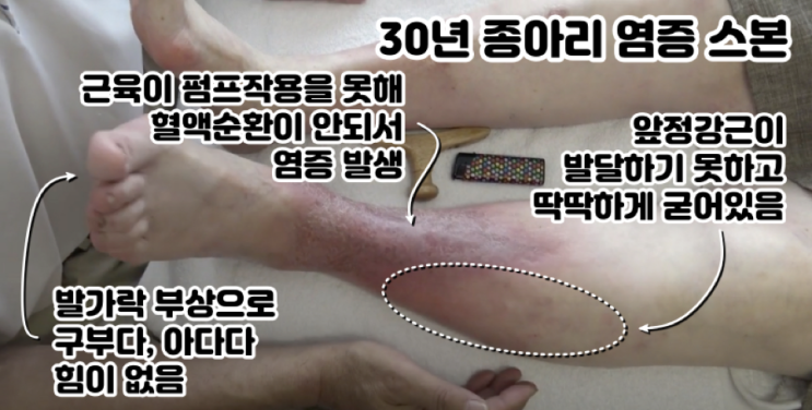 37. 혈액순환 고장 다리 만성 염증, 부종 KSNS KSS 스본 스도 5회 : 네이버 블로그