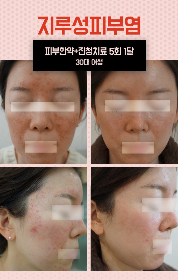 이유없이 생긴 30대 여성 지루성 피부염 가을철 속건조 치료해야 지루성피부염 한의원 네이버 블로그
