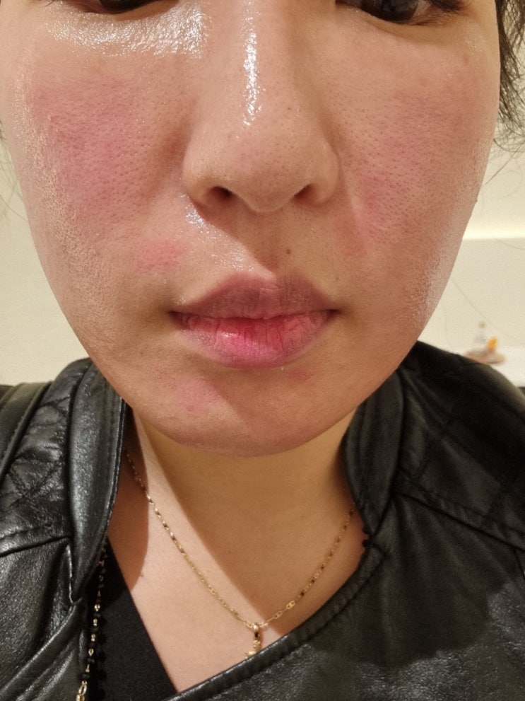 튠페이스후기 효과통증주기엘디엠물방울리프팅호텔같은 청담피부과 리프팅관리끝판왕 네이버 블로그