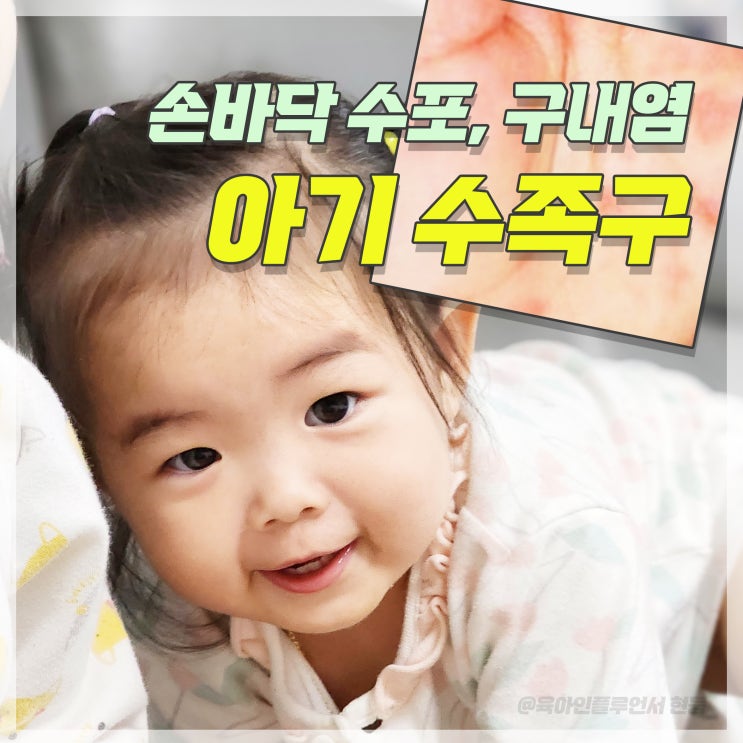 아기 수족구 증상 어린이 구내염 원인 잠복기 유아 입안 손바닥 피부 수포 네이버 블로그