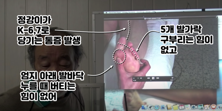 5. 발 신경 근육 통증 2, KSNS 스본과 스도 과정 : 네이버 블로그