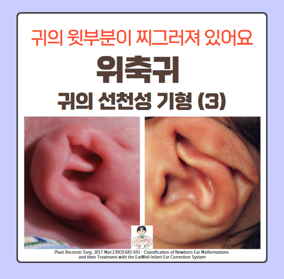 귀의 선천성 기형 (3) - 위축귀(Constricted ear) = 배상귀(Cup ear) = 토이(Lop ear) : 네이버 블로그