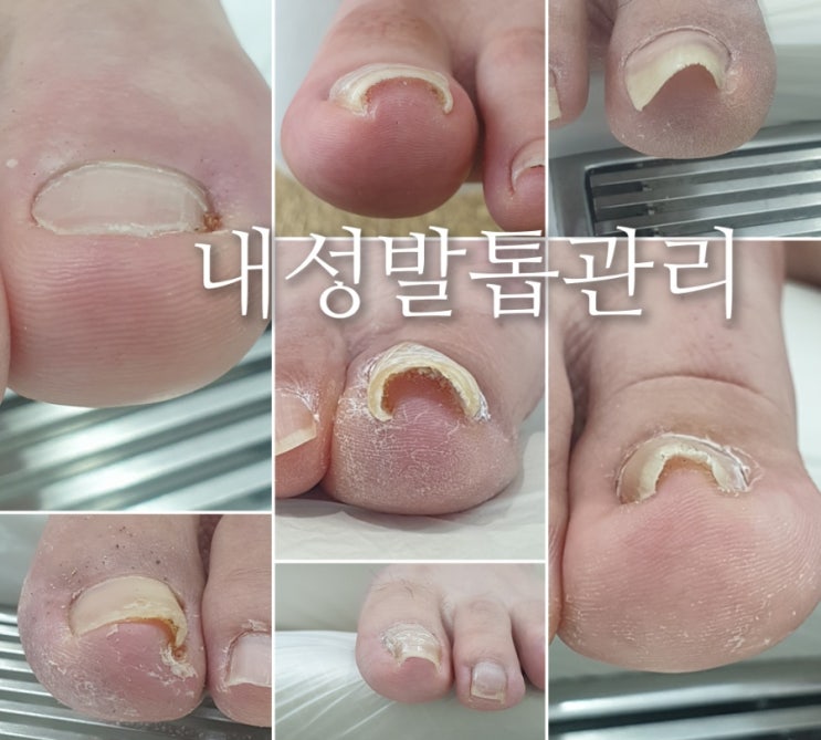 발톱자르는방법내성발톱예방하는 발톱자르기건강한발톱관리김포내성발톱교정닥터아이티엔김포점 네이버 블로그