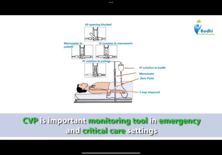 중심정맥압 의학용어 CVP (Central venous pressure) 와 평균동맥압 MAP 공부하기 : 네이버 블로그