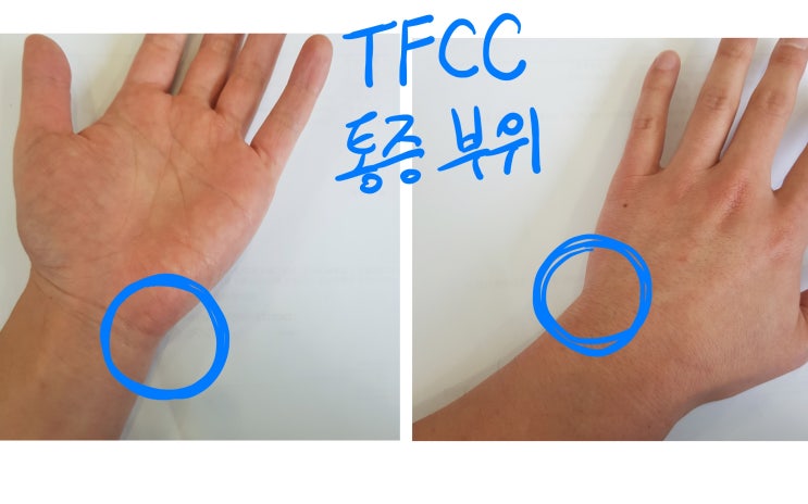 손목안쪽통증 / TFCC 치료 / 손목통증치료 / 주먹쥘때통증 / 손짚을때통증 : 네이버 블로그