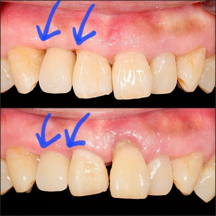 앞니 임플란트 잘하는치과, 이빨사이잇몸부터 다릅니다.(feat. creeping attachment '2탄') : 네이버 블로그