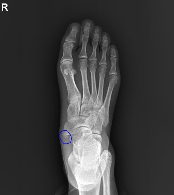 부주상골 증후군(ANS, Accessory Navicular Syndrome, prehallux syndrome) : 네이버 블로그
