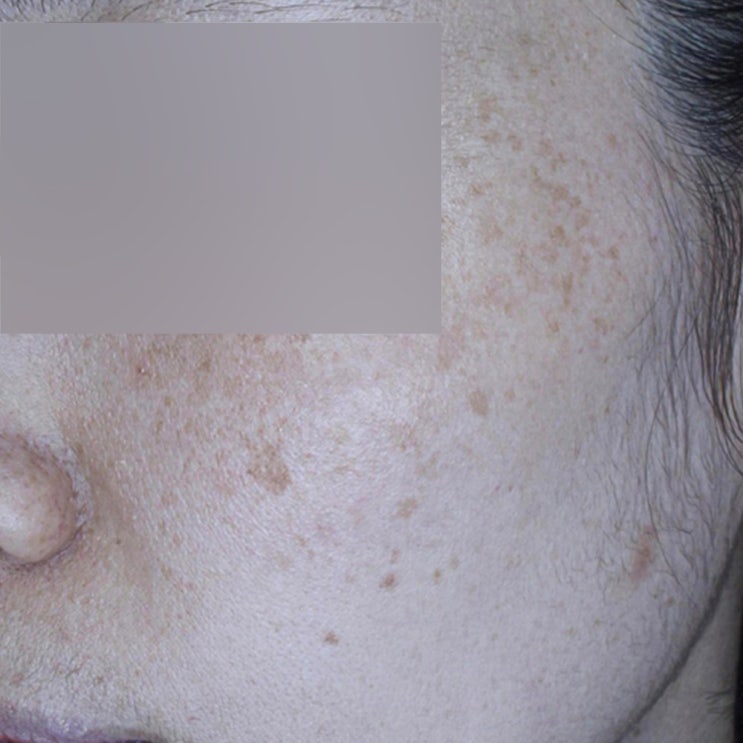 부산 수영구피부과 기미치료피코레이저와 레블라이트 복합 치료 효과 네이버 블로그