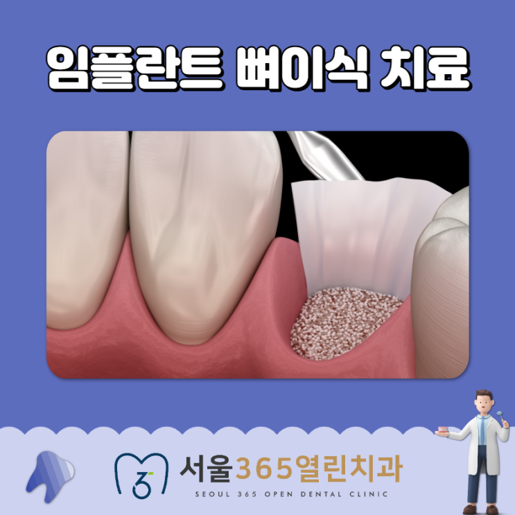 임플란트 뼈이식 치료 어떻게 하나요 네이버 블로그