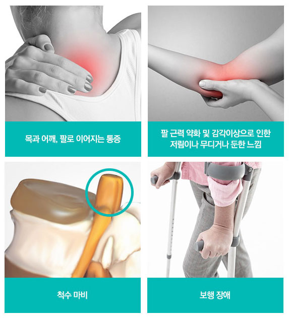 목 디스크로 인해 두통 발생 어깨 손 저림 등 통증 네이버 블로그