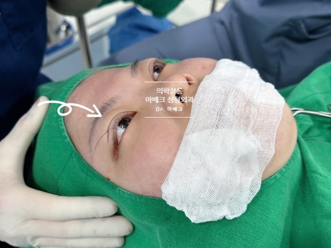Dr 아베크 【눈성형】 자연유착 수술방법 및 회복 수술전후 네이버 블로그