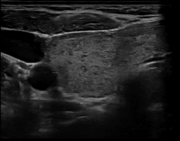 [Hashitoxicosis Case] 갑상선항진증으로 발현된 하시모토 갑상선염 임상경과, 진단 및 치료 정리 : 네이버 블로그