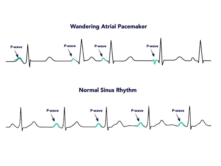 심전도로 보는 부정맥[15] - Wandering atrial pacemaker[유주성 심박 조율기, WAP] : 네이버 블로그