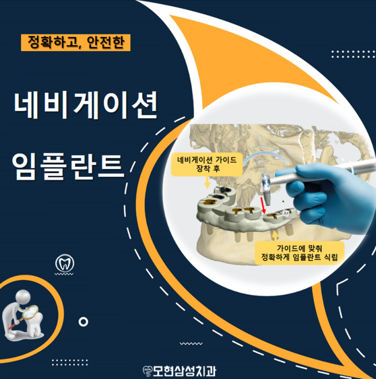 【모현삼성치과】 안전하고든든한익산네비게이션임플란트 네이버 블로그