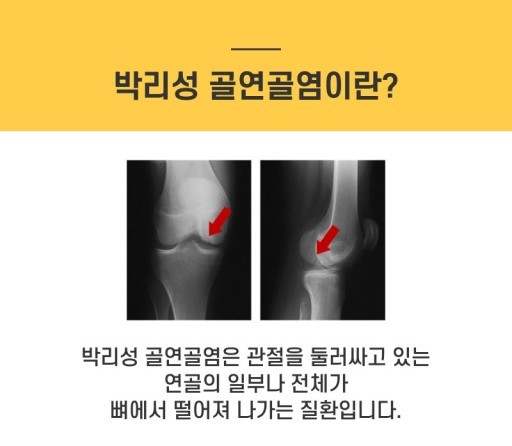 청소년 팔꿈치 바깥쪽 통증 박리성골연골염 Ocd 과 Panner's 병 네이버 블로그