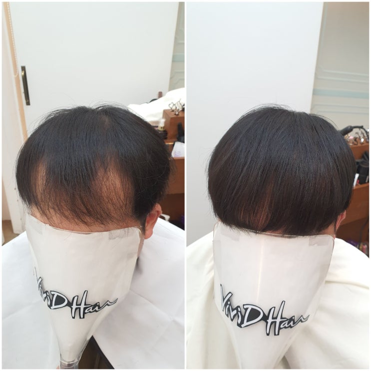 창원 남자 탈모머리숱 없는 증모술 붙임머리 종류에 맞게 헤어스타일 찾아 네이버 블로그