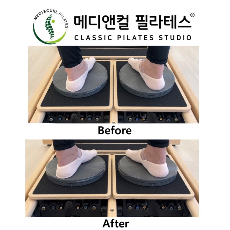 천안 필라테스신불당 재활전문 메디앤컬필라테스의 비포애프터 전문적인 11 시그니처 프로그램 개인레슨 네이버 블로그