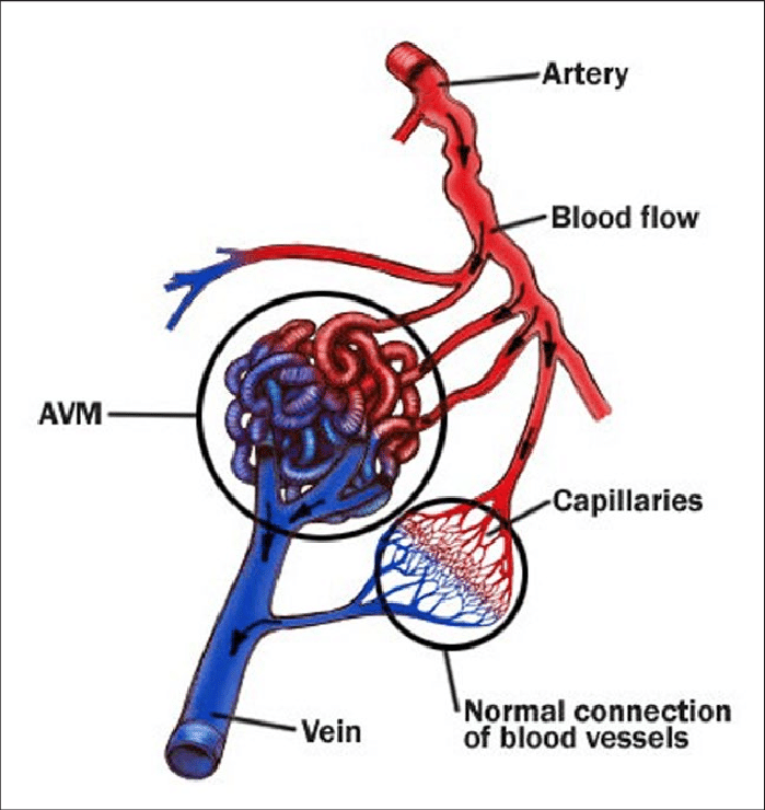 혈관종 및 혈관기형의 인터벤션 : 동정맥기형(Arteriovenous malformations;AVM) : 네이버 블로그