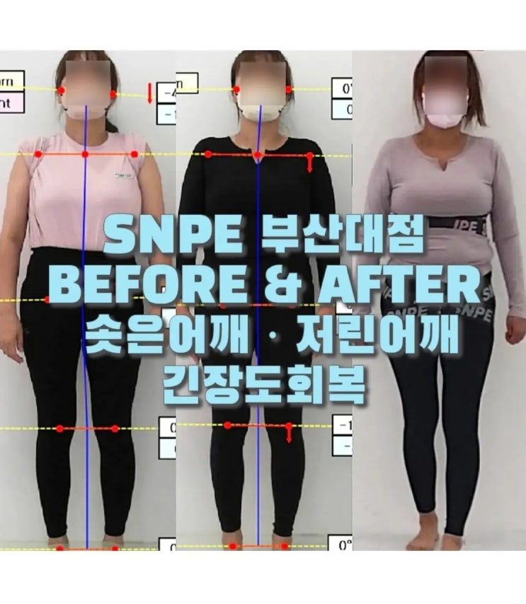 [SNPE 부산대] 솟은어깨ㆍ저린어깨 긴장도 회복 비포애프터 : 네이버 블로그