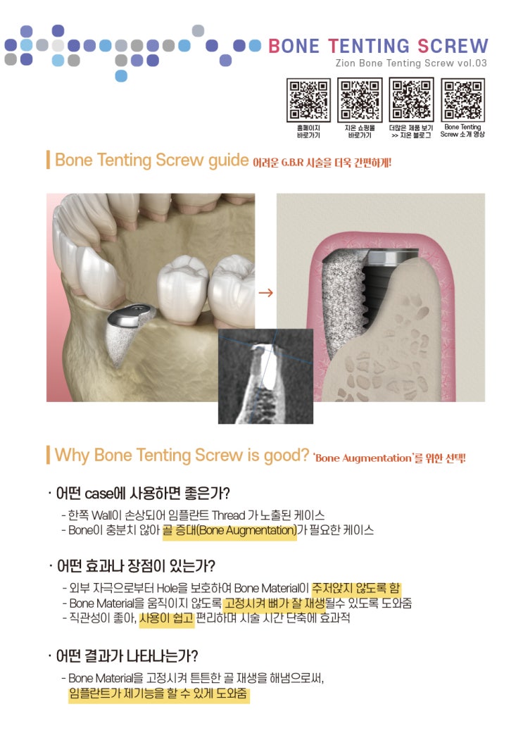 (주)지온 Bone Tenting Screw : 네이버 블로그