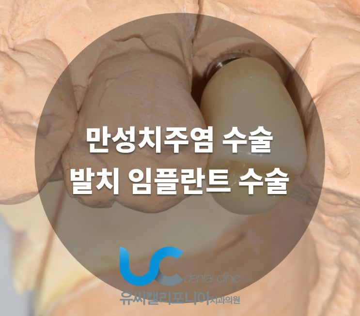 만성 치주염 수술 통증 심해, 치료 보단 차리리 발치 임플란트 수술 완성 후기 : 네이버 블로그