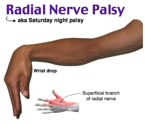 Wrist drop, Radial nerve palsy (요골 신경 마비) : 네이버 블로그