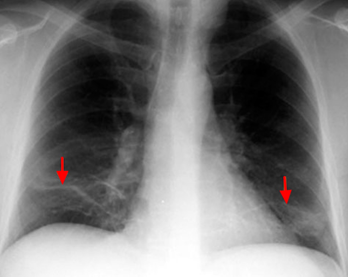 내과 흉부판독 소견 Subsegmental atelectasis 무기폐 : 네이버 블로그